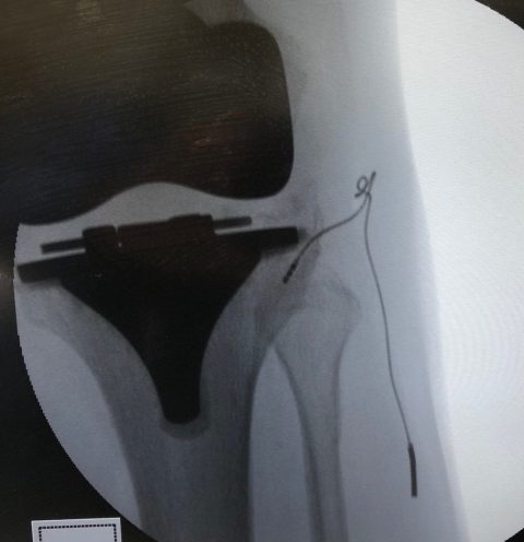 Infero-Lateral Genicular PNS - American Society For Post Surgical Pain